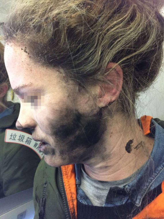 PHOTO/ An Australian woman's earphone explodes while sleeping on a ...