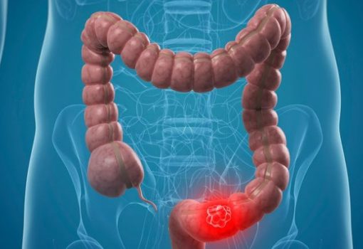 Simptomat e kancerit të zorrës së trashë që duhet t’i dini, edhe nëse ...